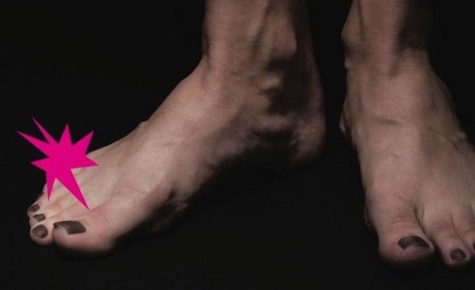 Black Toenails And How Runners Can Treat And Prevent Them