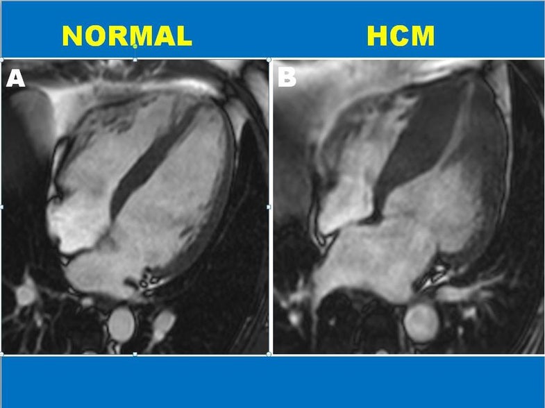 Running With The "Silent Killer" Heart Condition HCM